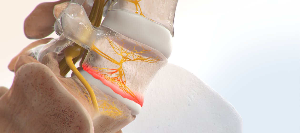 The Intracept® Procedure - Plymouth Bay Orthopedic Associates, Inc.